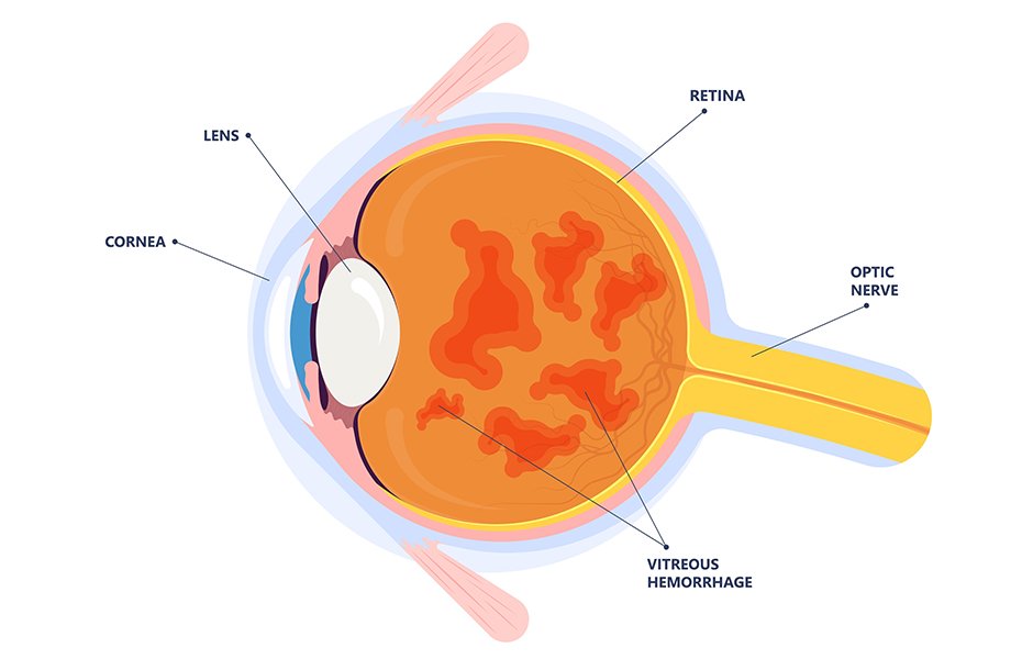 Vitreous Hemorrhage Or Opacities | Dr Mandeep Lamba